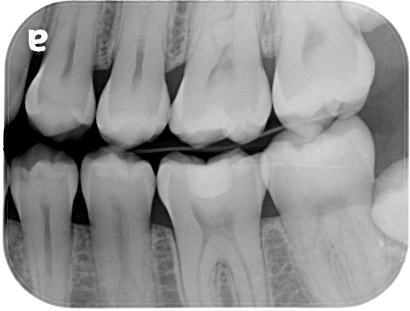 Why do I need Dental XRays? - DBay Dental