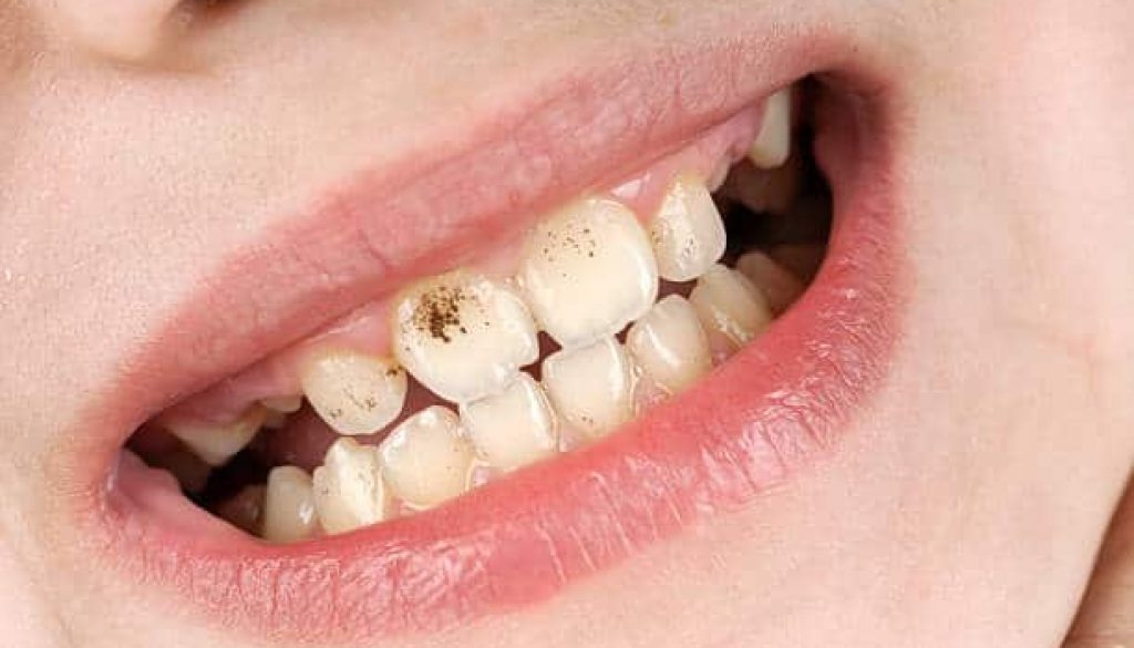 Teeth Staining – How is it caused? - DBay Dental